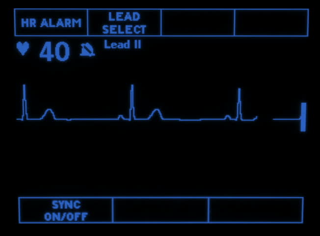Heart Monitors Arrhythmia